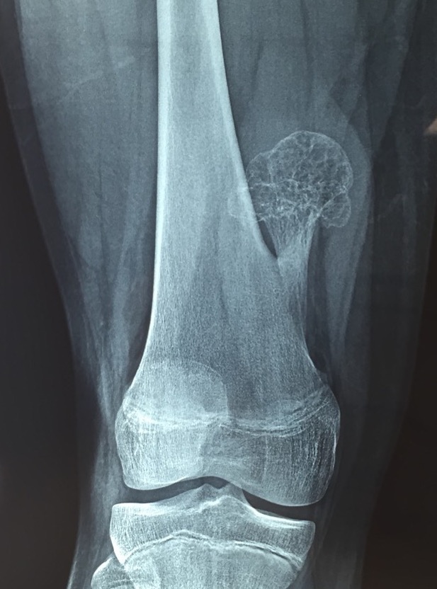Solitary osteochondroma | The Bone School